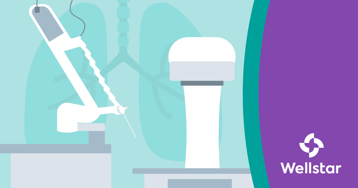 Lung Biopsy Technology at Wellstar Reduces Complications, Speeds Up ...